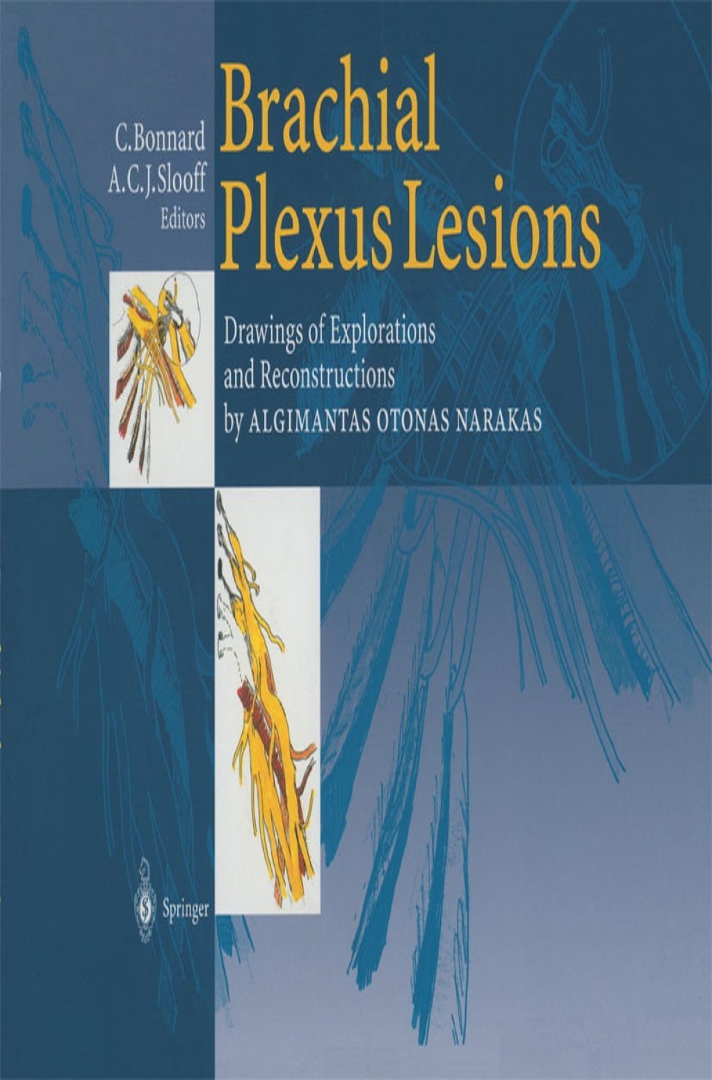 Brachial Plexus Lesions Drawings of Explorations and Reconstructions by ...