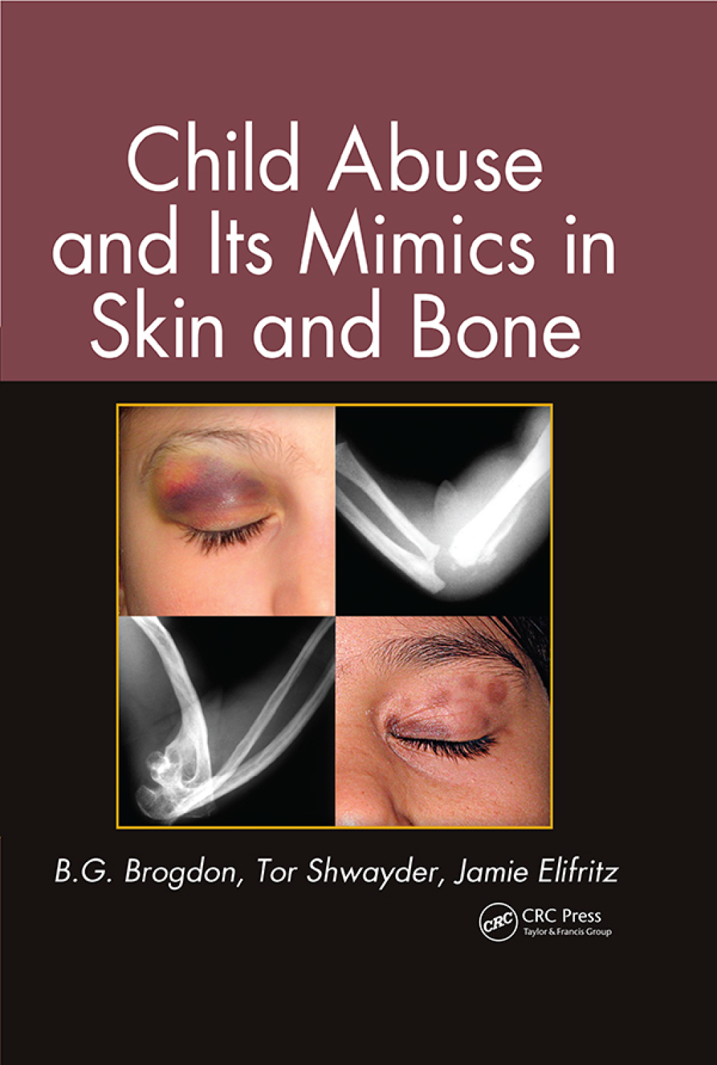 Child Abuse and its Mimics in Skin and Bone 1st Edition â€“ PDF/EPUB ...