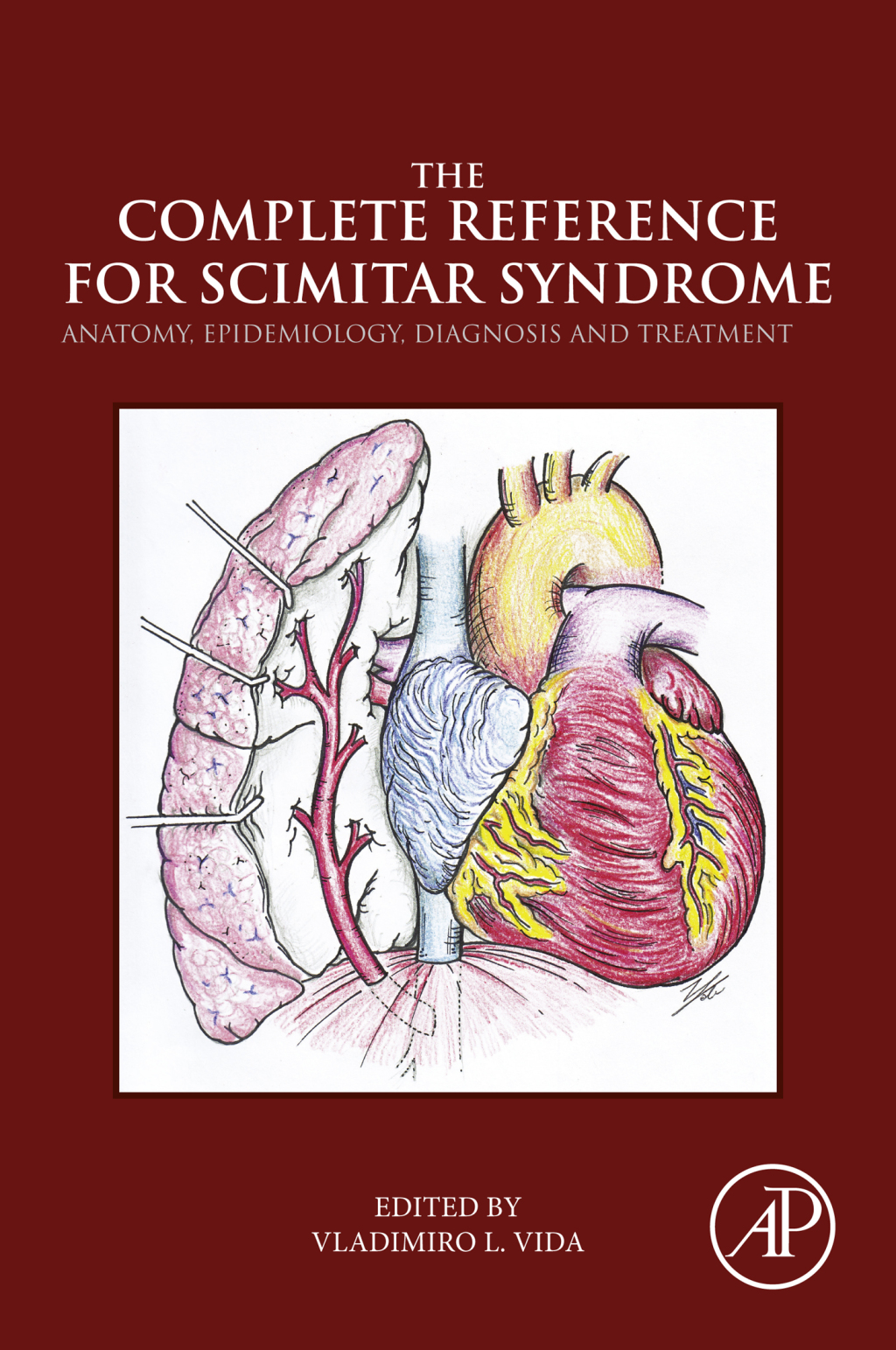 The Complete Reference for Scimitar Syndrome Anatomy, Epidemiology ...